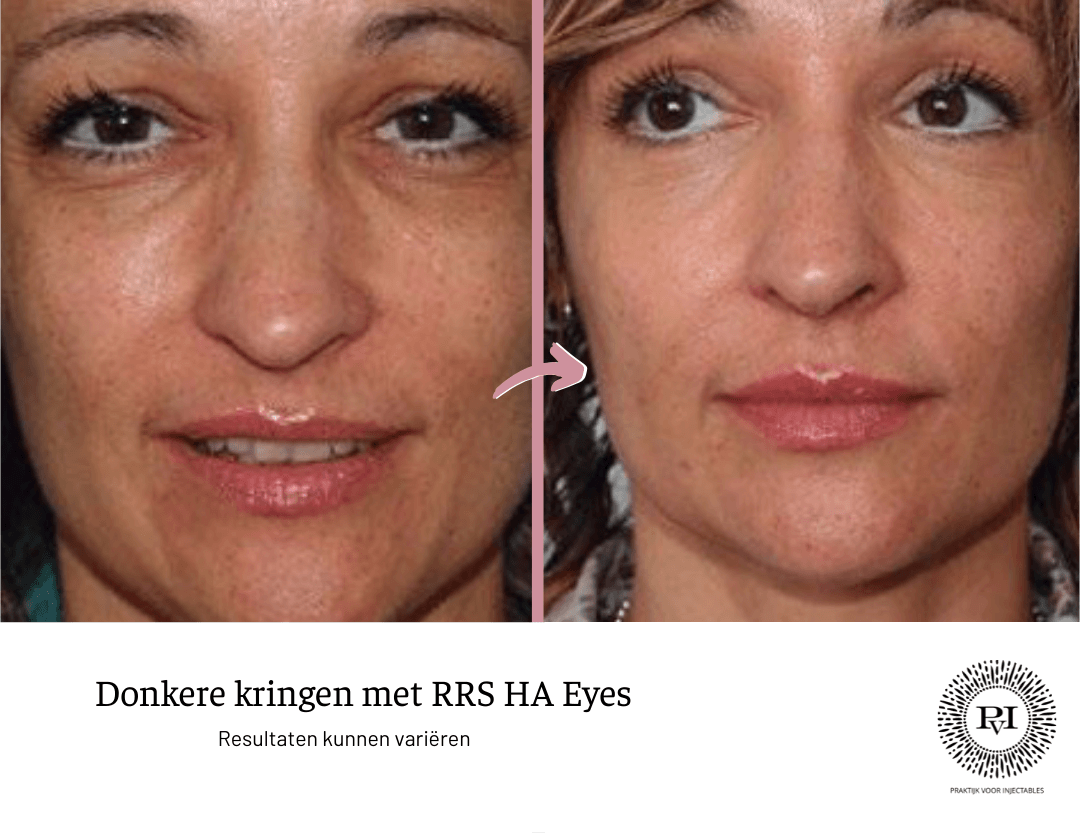 RRS HA Eyes (voor donkere kringen) - Praktijk voor Injectables