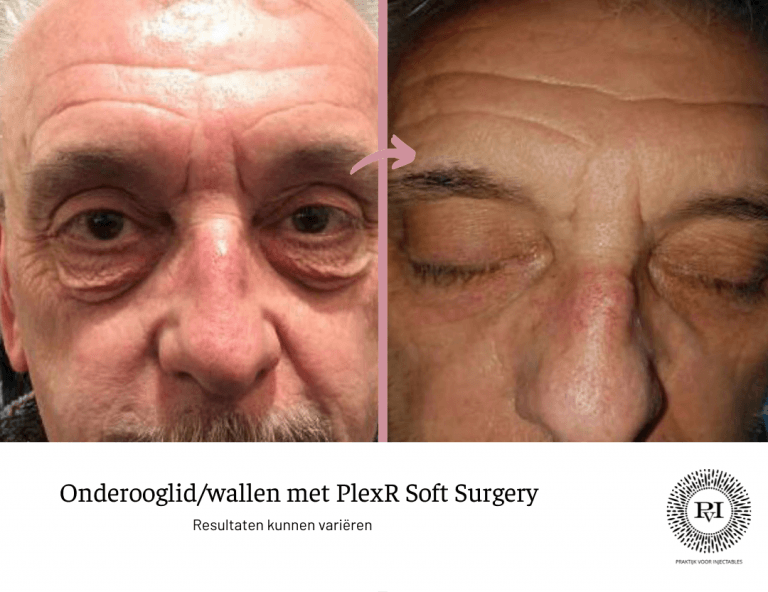 Plexr Soft Surgery - Praktijk voor Injectables