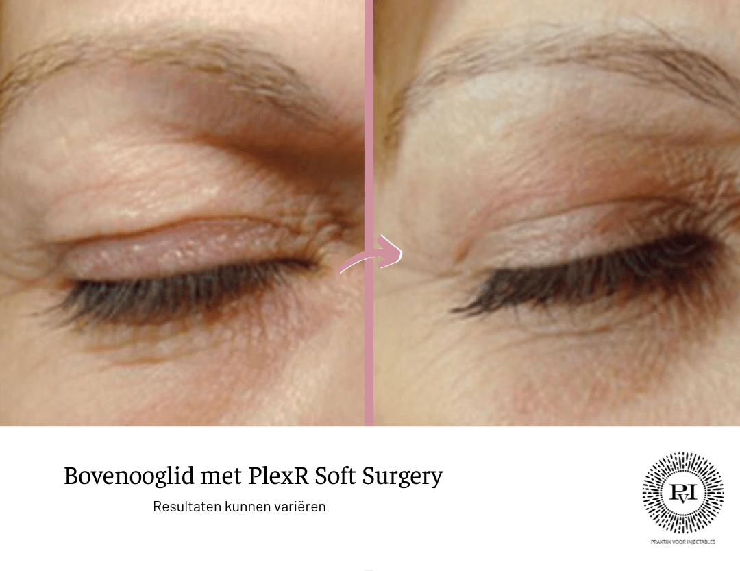 Plexr Soft Surgery - Praktijk voor Injectables