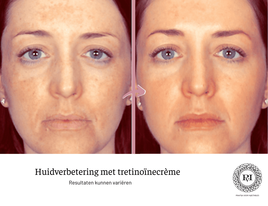 Tretinoïne crème - Vitamine A zuur crème - Praktijk voor Injectables.